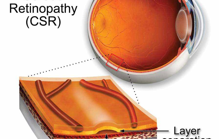 Central Serous Chorioretinopathy Cscr نظارتي كوم